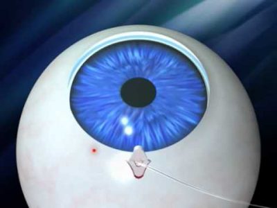 Canaloplasty – Ophthalmic Singapore
