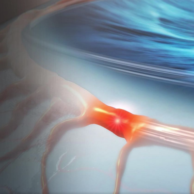 Canaloplasty – Ophthalmic Singapore