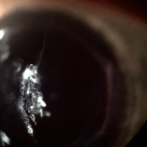 Tango Reflex – Ophthalmic Singapore