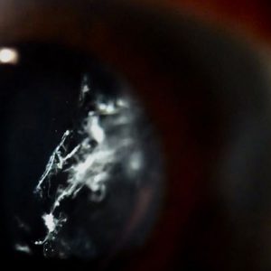 Tango Reflex – Ophthalmic Singapore