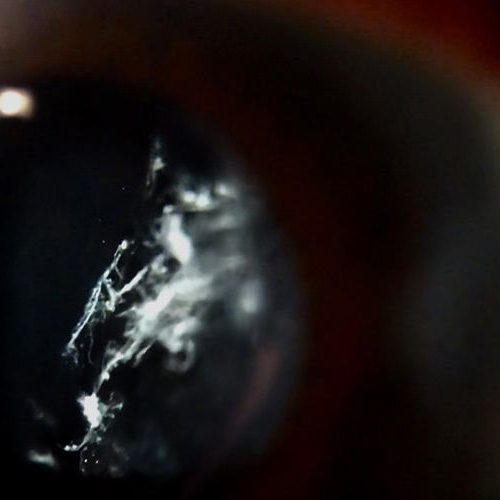 Tango Reflex – Ophthalmic Singapore