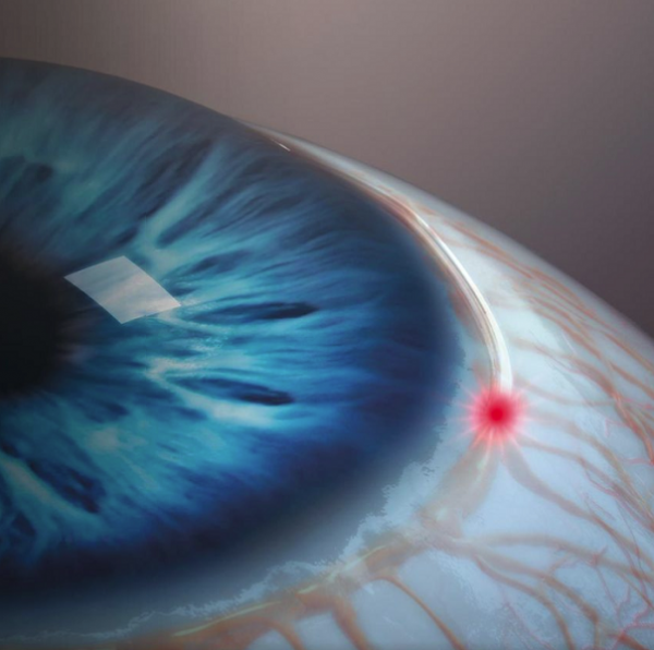 ABiC™ – Ophthalmic Singapore